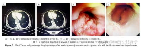 基于卡瑞利珠单抗的方案治疗局部晚期及转移性食管癌的真实世界研究 知乎