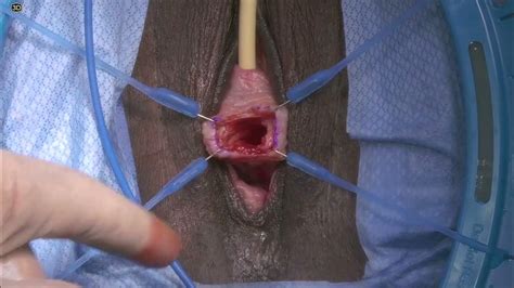 Modified Marsupialization Urogynecology Journal Youtube