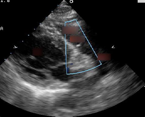 Plax Rv Outflow View Diagram Quizlet
