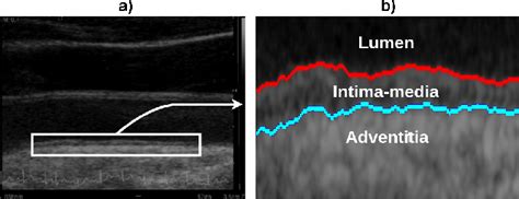 Figure 1 From Carotid Artery Wall Segmentation In Ultrasound Image Sequences Using A Deep