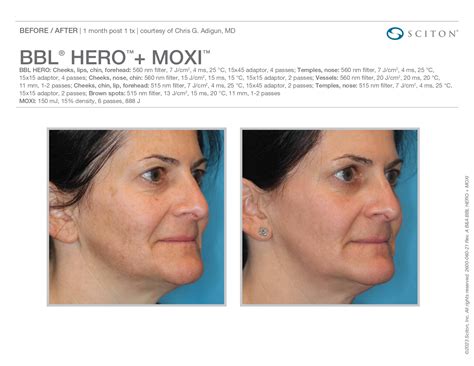Moxi In Florence KY Skin Rejuvenation Treatment