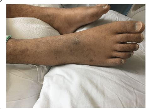 Hyperpigmentation In The Right Foot Download Scientific Diagram