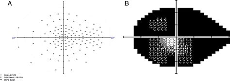 Branch Retinal Artery Occlusion Visual Field Defect