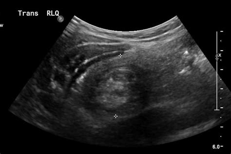 Imaging In Intussusception Sinaiem