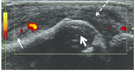 Representative Longitudinal View Of The Right Third Metacarpophalangeal