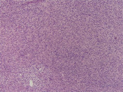 Photomicrograph Showing A Spindle Cell Neoplasm With Irregular