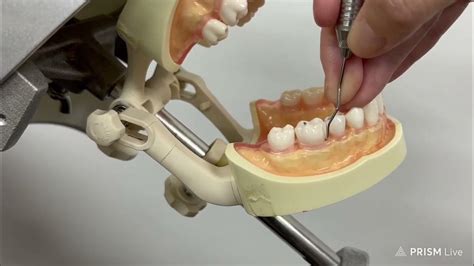 치석탐지동작하악우측구치부협면 치과위생사국가실기시험 대비 Youtube