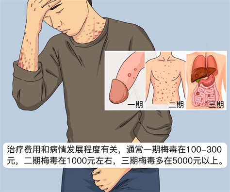 治疗梅毒要多少钱 有来医生