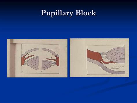 Ppt Laser Therapy In Glaucoma Powerpoint Presentation Free Download Id 177090