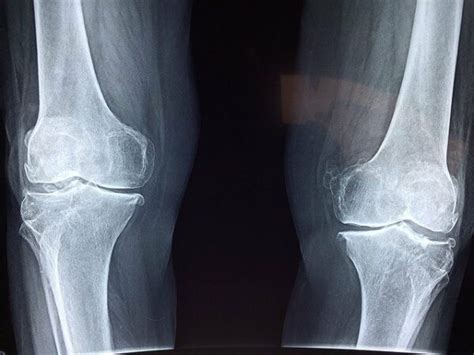 Bisphosphonate Comparison Table And Clinical Pearls I Care