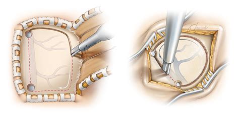 Interhemispheric Craniotomy The Neurosurgical Atlas
