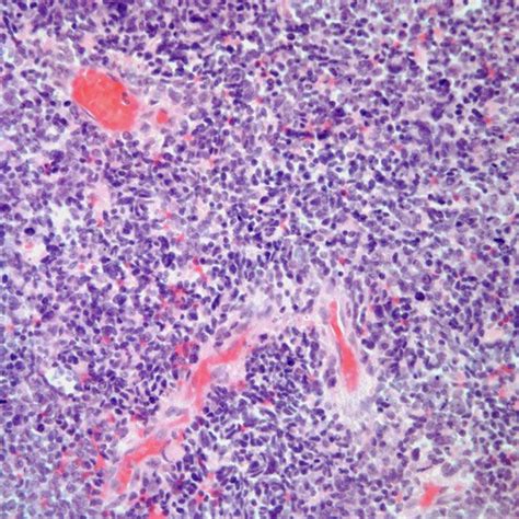 Dostarlimab Chemo Improves Os Vs Chemo In Advanced Endometrial Cancer