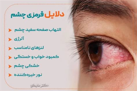 علت قرمزی چشم چیست؟ درمان فوری قرمزی چشم راست وچپ دکترمایکو