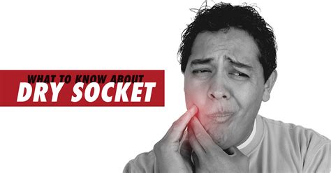 What You Need To Know About Dry Socket Fiorillo And Filstrup Dentistry Blog