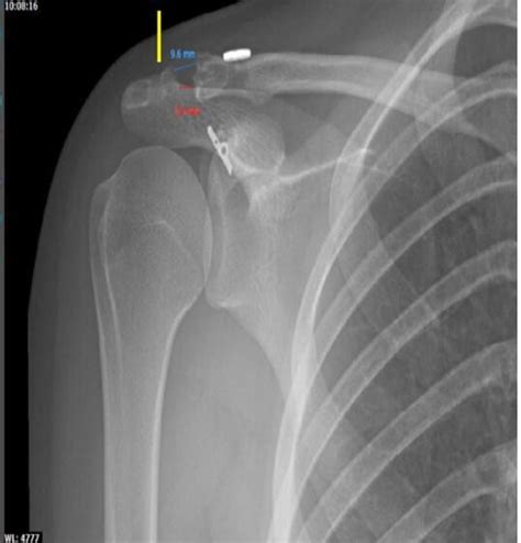 5 5 Years Post Surgery Radiographic Control Correct Acromioclavicular Download Scientific