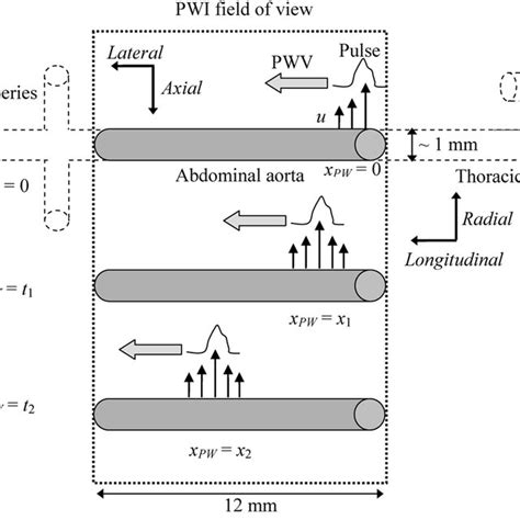 Illustration Of The Pulse Wave Propagation Along The Abdominal Aorta