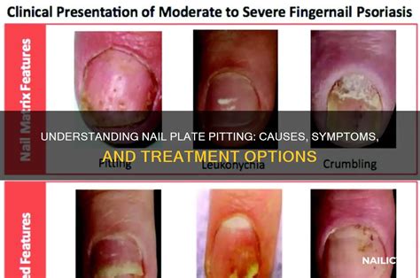 Understanding Nail Plate Pitting Causes Symptoms And Treatment