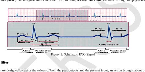 figure 1 from design and comparison of digital iir filters for reduction of artifacts from