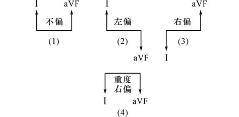 电轴偏向的判断方法 临床心电图 医学