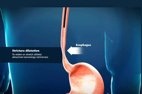 Esophageal Stricture Dilatation Gastro Skin Care Nagpur