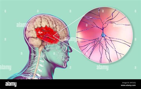 Human Brain With Highlighted Temporal Lobe And Close Up View Of Neurons Located In Temporal Lobe