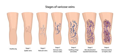 Varices Acveq