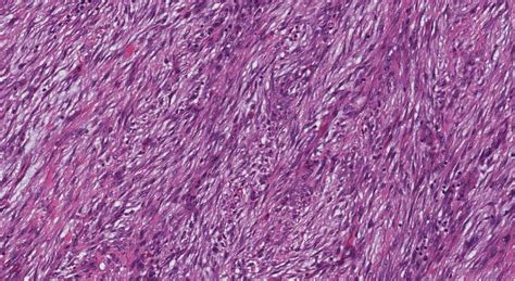 Nodular Fasciitis Atlas Of Pathology