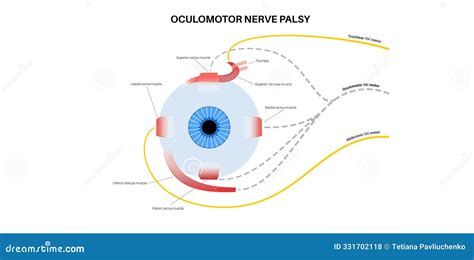 Oculomotor Nerve Palsy Cartoon Vector 329684367