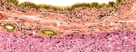 Percutaneous Transhepatic Cholangiogram