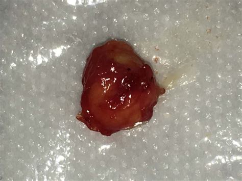Dermoid Cyst Excision Tahiri Plastic Surgery
