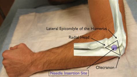 Arthrocentesis Of The Elbow Joint Internet Book Of Msk Ultrasound