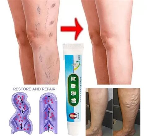 Pomada Varizes Pomada Para Úlceras Nas Pernas Creme Circulaç Mercadolivre