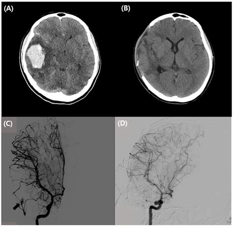 Georgia College Student On Life Support With Brain Bleed After Trip To