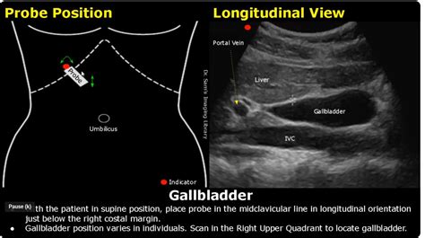 Gallbladder Ultrasound Probe Positioning Transducer Placement