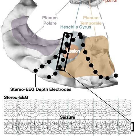 Superior Temporal Plane Reconstruction Of The Suspected Seizure Focus Download Scientific