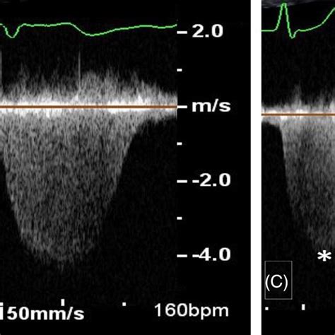 Diagnostic Algorithm For Discrimination Of Group 1 Pulmonary Arterial Download Scientific