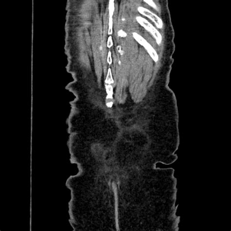 File Small Bowel Volvulus Causing Small Bowel Obstruction Mimicking Intussusception