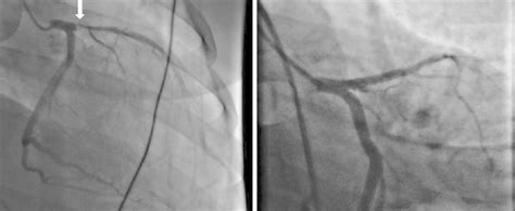 A Coronary Angiogram Revealing A Subtotal Ostial Occlusion And Download Scientific Diagram