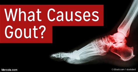 What Causes Gout