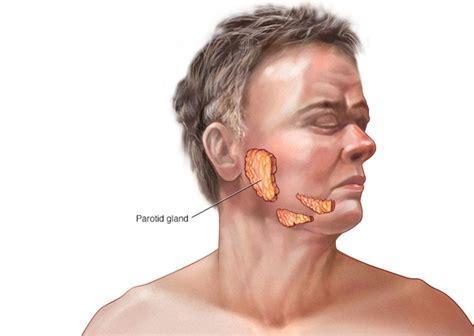 أسباب تورم الغدد النكافية وأهم أعراضها