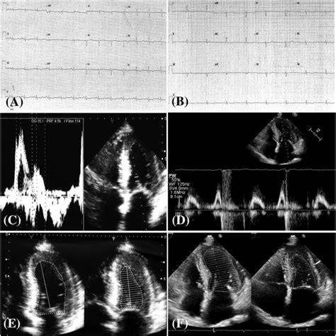 Comparison Between Electrocardiogram And Echo Findings At Baseline And Download Scientific