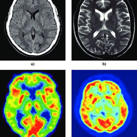 Pdf A Novel Method Of Multimodal Medical Image Fusion Based On Hybrid Approach Of Nsct And Dtcwt