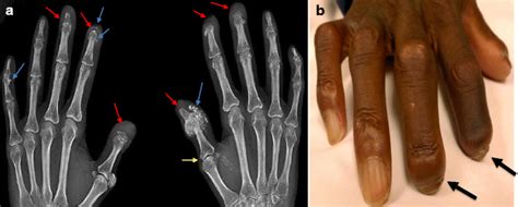 Acro Osteolysis A Plain Radiographs With Resorption Of Bilateral 1st Download Scientific