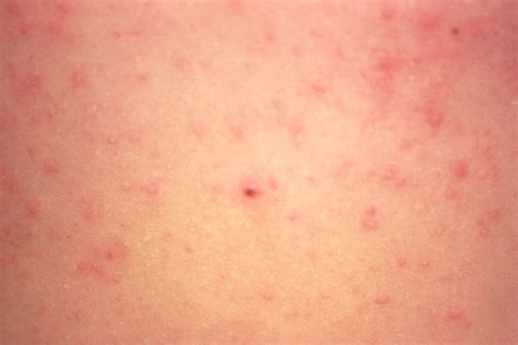 Scabies Bites Vs Bed Bug Bites
