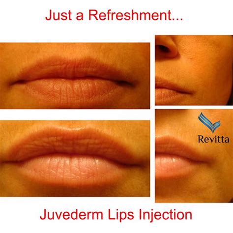 Juvederm Lip Enhancement The Secret To A Fresher And Sexier Lips
