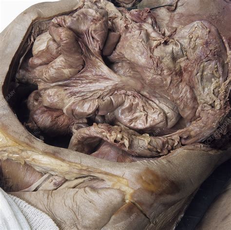 Cadaver Dissection Stock Image C0126313 Science Photo Library