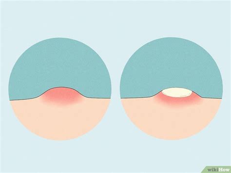 How To Get Rid Of Pimples On Your Pubic Area For Males