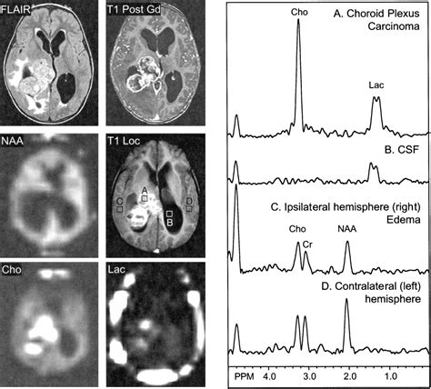 Choroid Plexus Carcinoma