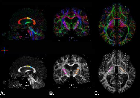 Dti Derived Color And Fa Maps Depicting Region Of Interest Drawings From A Representative