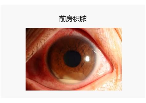 眼睛是风湿的窗户 葡萄膜炎的诊断和治疗策略